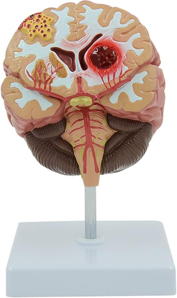【精密な構造、脳卒中病変の詳細を再現】本書は脳卒中の病理構造を忠実に再現し、出血巣や患部などの病変部位を明確に示しています。明確な解剖学的層構造により、教育現場でも一般教育現場でも、精密な教材として活用できます。 【直感的なデモンストレーシ...
