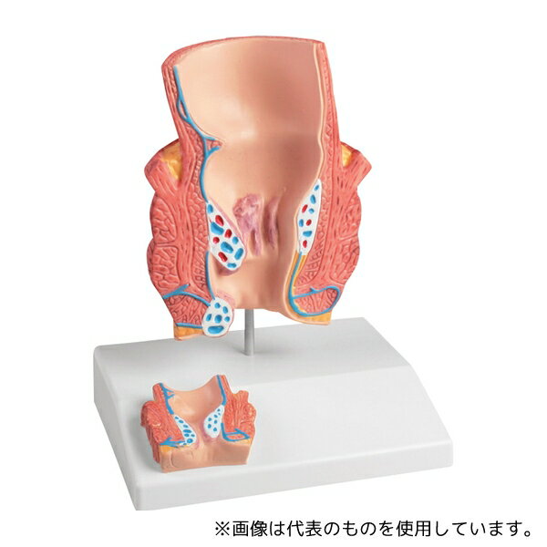 【アズワン AS ONE】看護、介護用品 処置・手術 看護・介護用教材(人体モデル等) ●直腸末端面断面モデルで外核痔およびステージI/IIを再現しています。 ●直腸や括約筋、静脈叢の解剖学的構造も確認することができます。 ●スタンドには小...