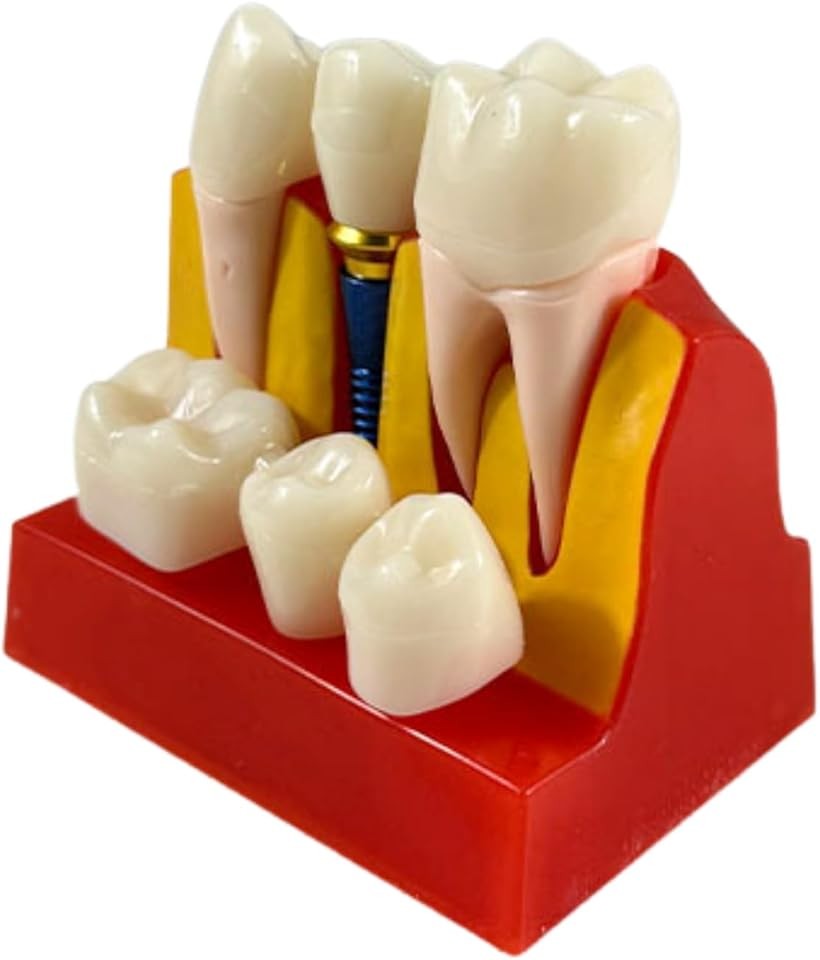 「取り外し可能なクラウン」インプラントの構造を着脱式クラウンでリアルに再現、学習に最適。「携帯に便利」丈夫で軽い樹脂素材が使われており、実習や移動にも便利です。「解剖学的な表面表示」歯肉断面まで再現されているから、解剖学的理解が深まります。...