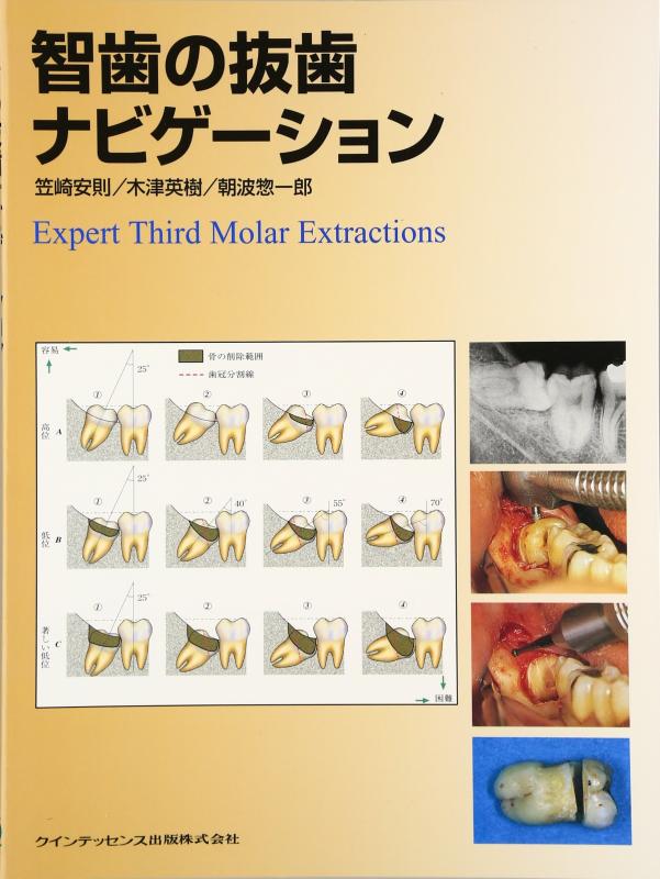 智歯の抜歯ナビゲ-ション